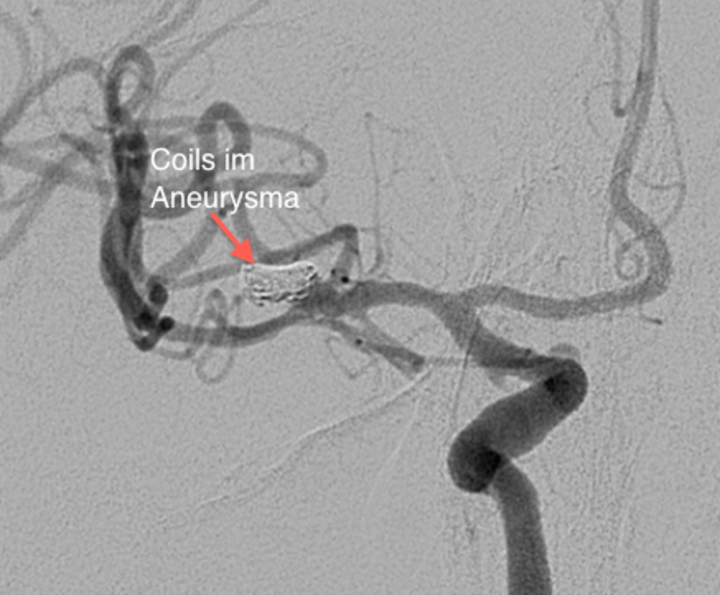 Gesundheit Nord: Minimal invasive Aneurysmatherapie (Aneuysma-Coiling)